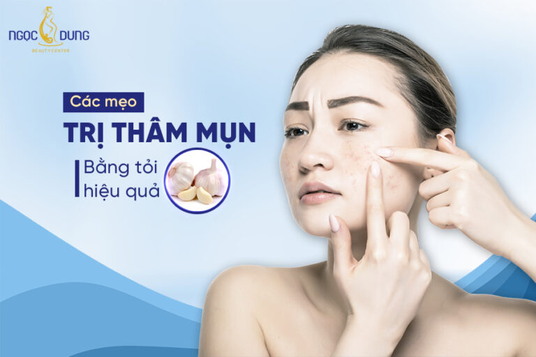 7 cách trị thâm mụn bằng tỏi an toàn và cực kỳ hiệu quả