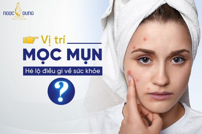 13 vị trí mọc mụn trên mặt - Lời cảnh báo về sức khỏe của bạn - Thẩm mỹ ...